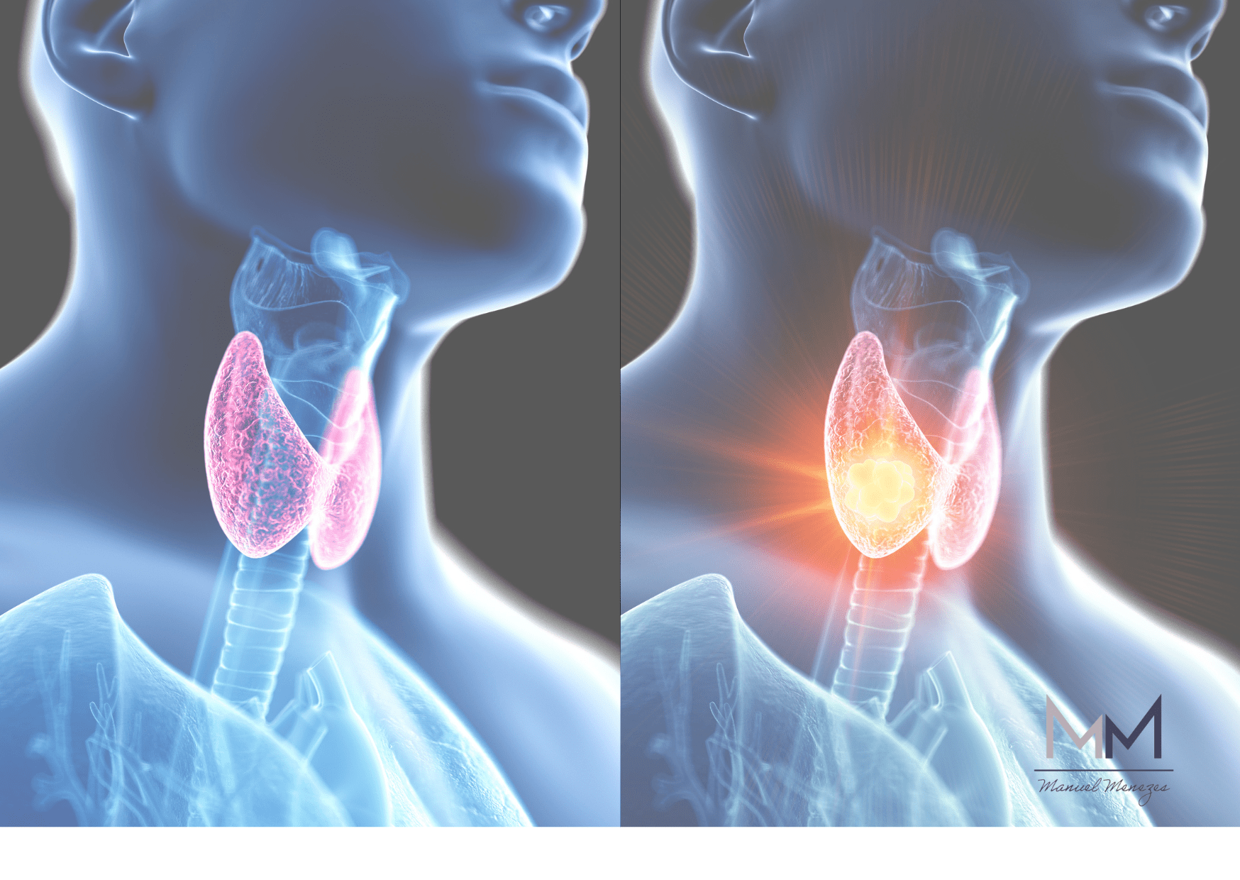 Nódulo na tireoide e Câncer de Tireoide - Dr Manuel Menezes